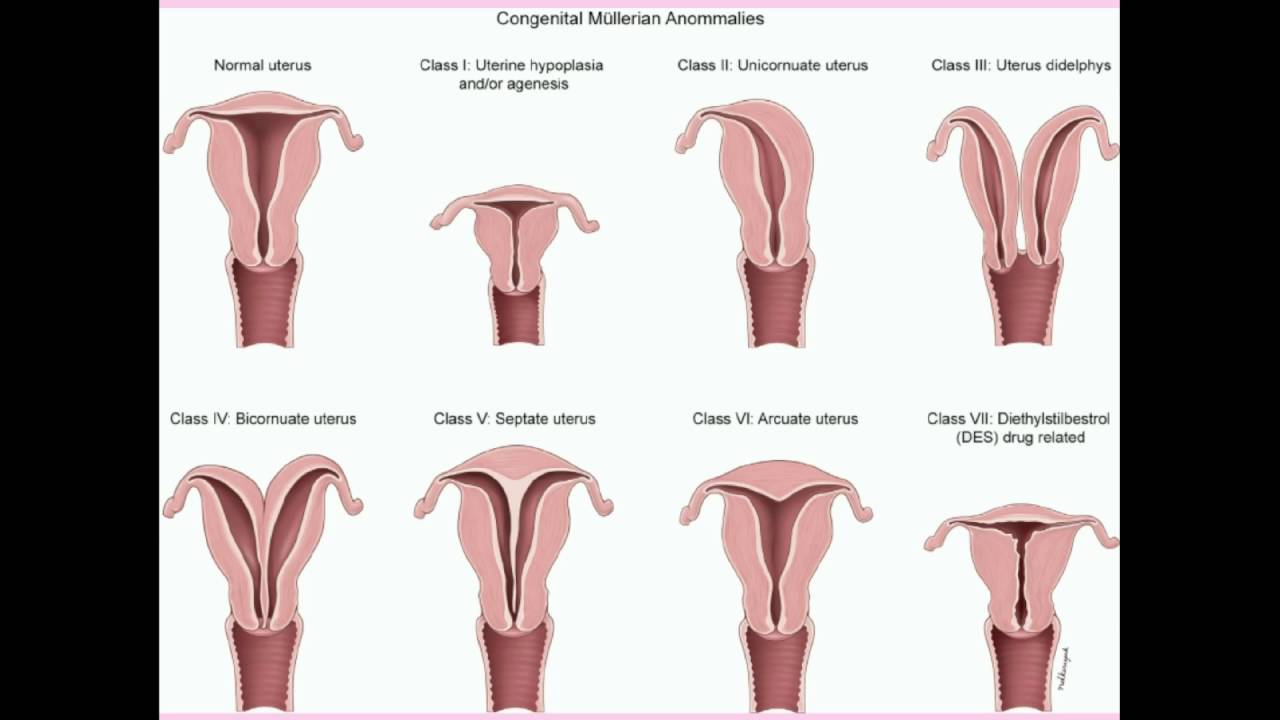 Congenital Uterine Abnormalities - CRASH! Medical Review Series