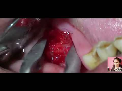 Molar Tooth extraction l extraction of molar root stump#extraction #dental #doctor #root