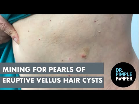 Dr. Pimple Popper Pops 'Pearl' Eruptive Cysts In New Youtube Video
