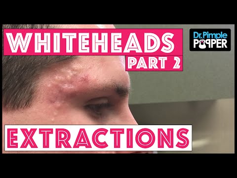 Dr. Pimple Popper Extracts Whiteheads Cysts From Teen On Youtube