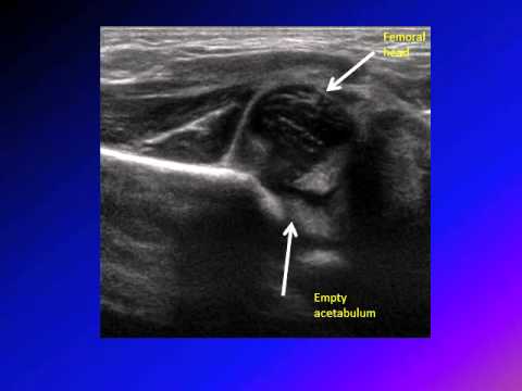Developmental Dysplasia of the Hip - Pediatrics - Orthobullets