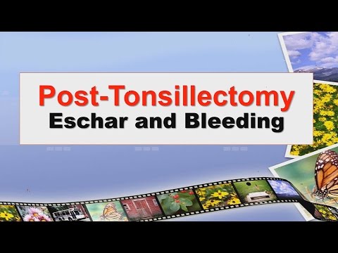 Post Tonsillectomy and Adenoidectomy Eschar and Bleeding