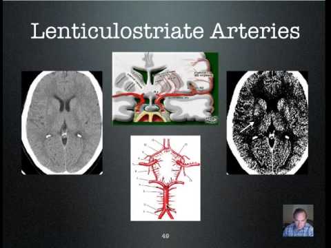 MRI & CT Stroke