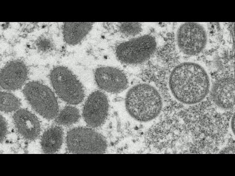 Monkeypox cases reported in United States, around the world