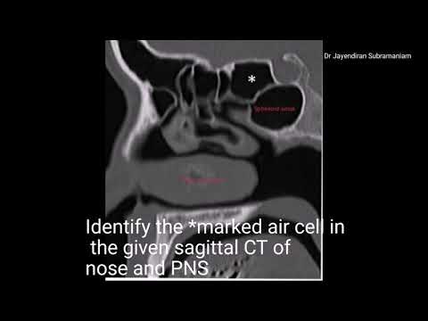 ENT image based question 60