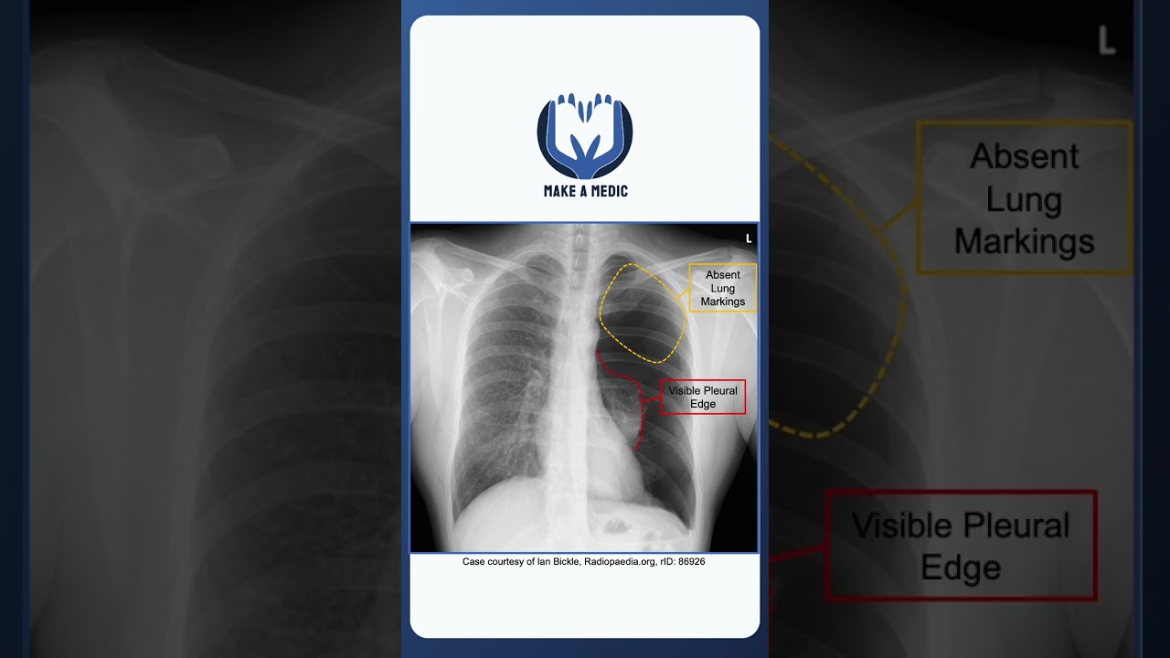 Pneumothorax on a Chest X-Ray #medicine