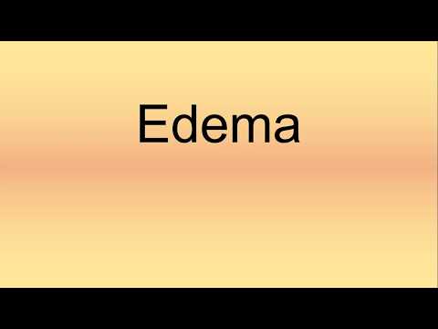 Edema Pronunciation | How to Say | How to Pronounce