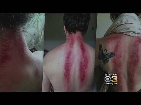 ‘Gua Sha’ Treatment Creates Bruises To Relieve Pain