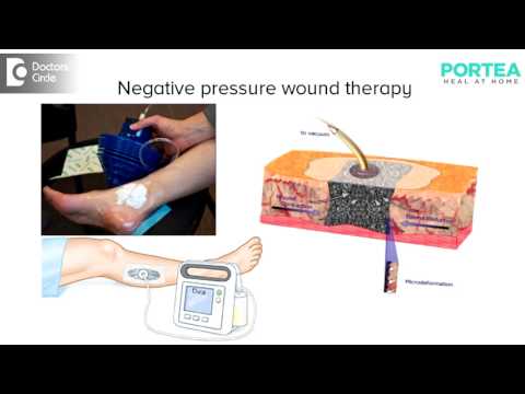 What is meant by negative pressure wound therapy? | Portea Medical