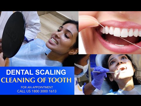 All about Dental Scaling Explain in Tamil
