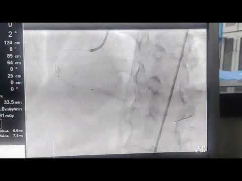 CTO (chronic total occlusion) of RCA #cardiology #education #medicaldoctor #medicine #angiogram