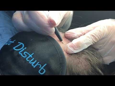 (Hairline Electrolysis) For Women