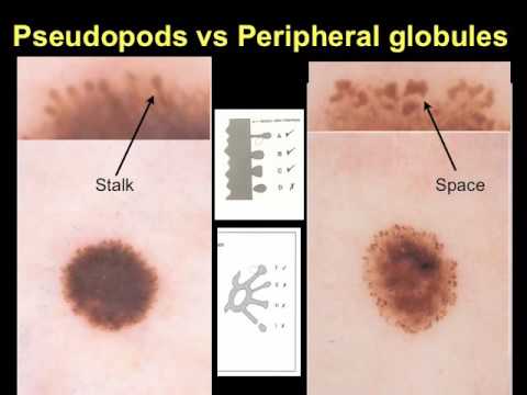 Melanoma specific criteria by Dr. A. Marghoob