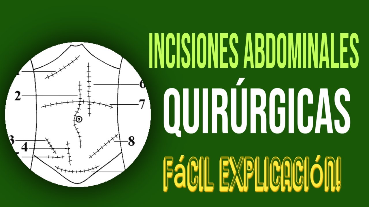 INCISIONES ABDOMINALES QUIRURGICAS. FÁCIL EXPLICACIÓN!