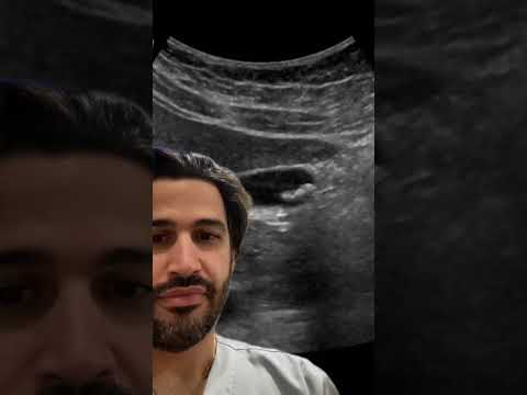 LLD for cholelithiasis