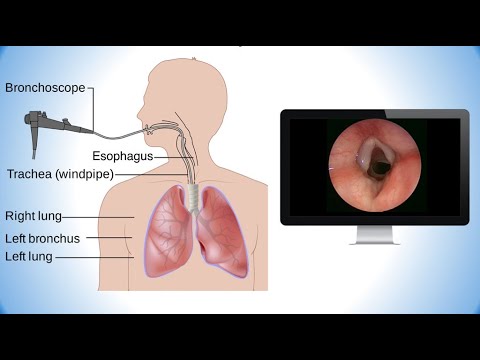 Bronchoscopy CPT code - simplify medical coding