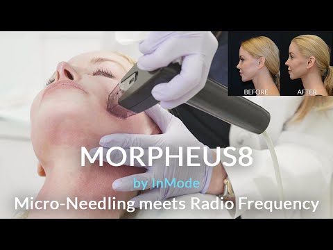 MORPHEUS8 by InMode; Micro-Needling meets Radio Frequency | Over 50