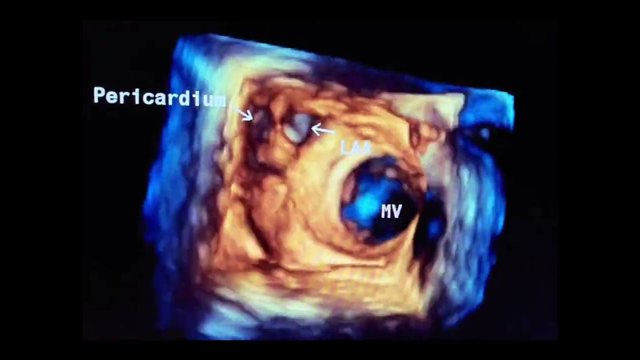 Pericardial Fibrin Clumps : A Common Mistake for Left  Atrial Appendage Clot