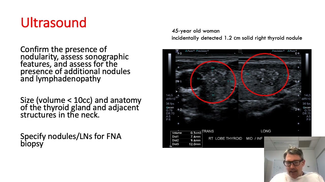 Work up of thyroid nodules