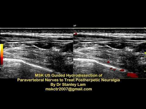 Ultrasound Guided Hydrodissection of Paravertebral Nerves to Treat Postherpetic Neuralgia