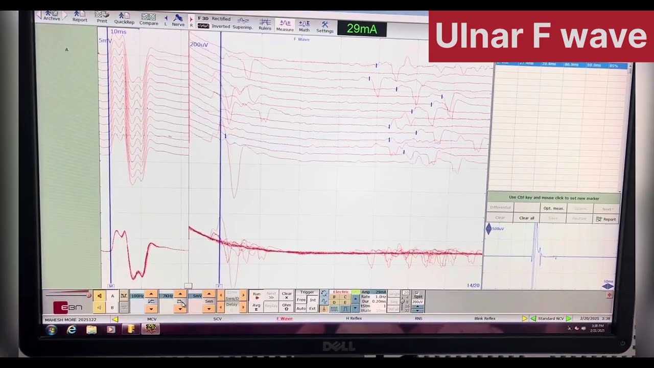 NCS || nerve conduction study #neuroscience #ncs
