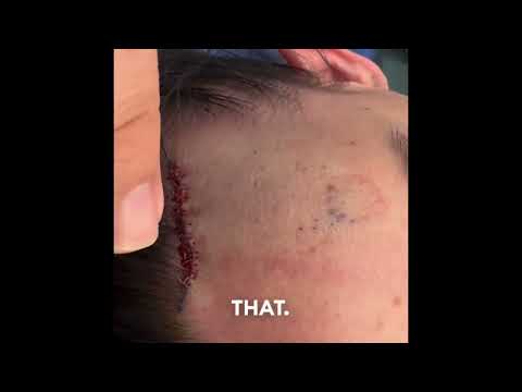 Osteoma or Lipoma Forehead Removal?
