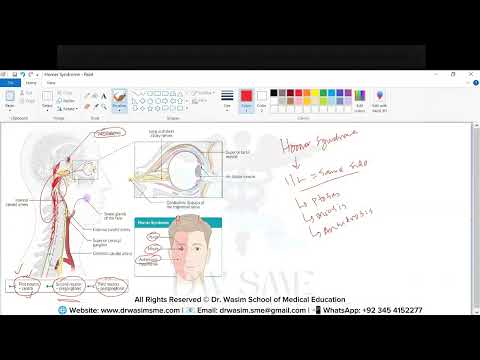 Horner's syndrome