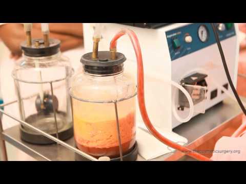 Liposuction Machine at Best Price in India