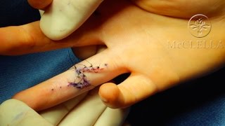 Z-plasty - Surgical Tech