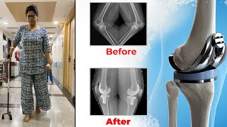 Best Orthopaedic Surgeon | Knee Replacement Dcotor In Delhi