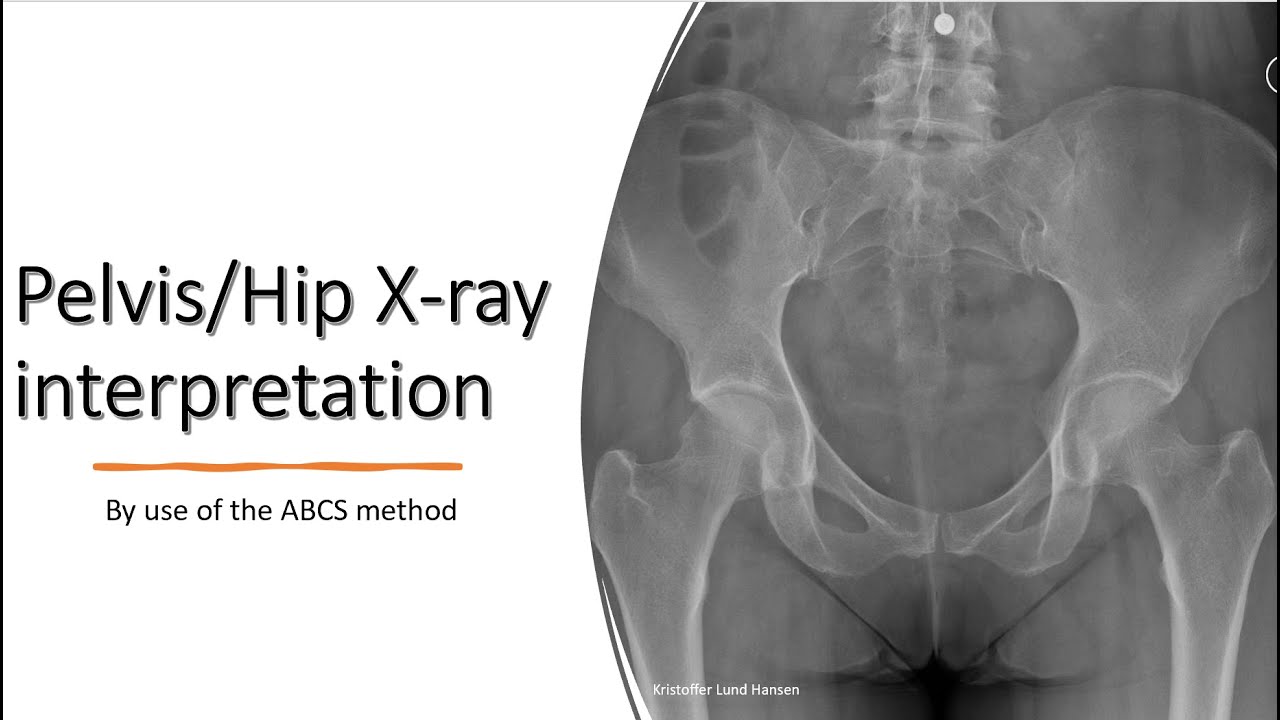 Pelvis/Hip X-ray interpretation