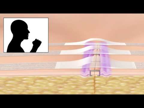 Incision support, SutureSafe