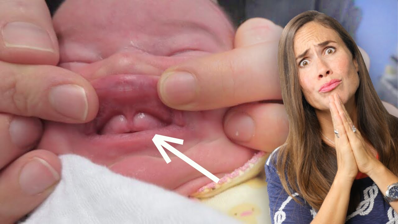 Lip Tie: How to Check Your Baby (And How to Fix it)