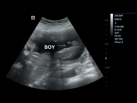 Ultrasound showing boy baby !!!🤰 | 23 weeks
