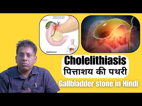Cholelithiasis - पित्ताशय की पथरी - लक्षण, कारण और उपचार | Gallbladder stone in Hindi