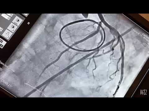 NSTEMI, Proximal LAD Stenosis, provisional Stenting, JL 4