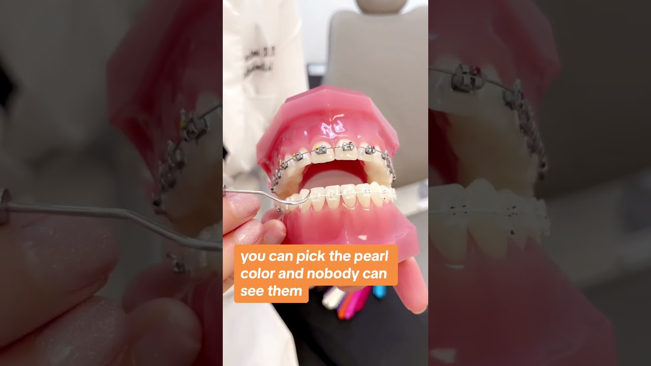 Braces: Clear or Metal?