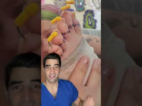 Fix toe fractures with pins