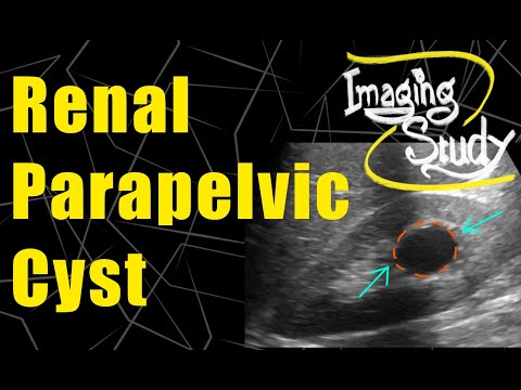 Renal Parapelvic Cyst - Bosniak Grade-I || Ultrasound || Case 83