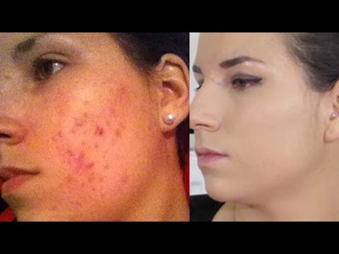 Comment traiter les gros boutons d'acné ? La réponse est sur Admicile.fr