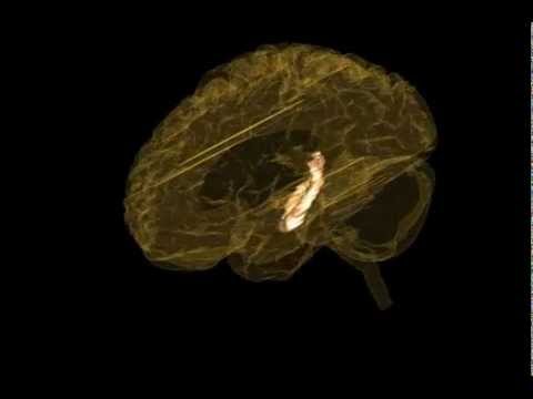 3D Brain from MRI 7 Hippocampus