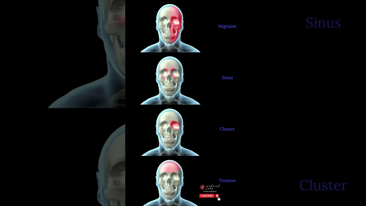 Different Types Of Headaches: Migraine, Sinus, Cluster, Tension.. #shorts