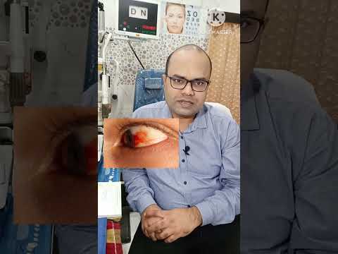 Red eye | subconjunctival haemorrhage | #shorts #eyecare #viral #eye #reels