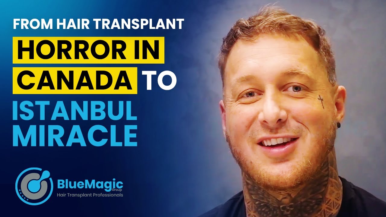 Bad Hair Transplant: What to Look Out For - BlueMagic Group