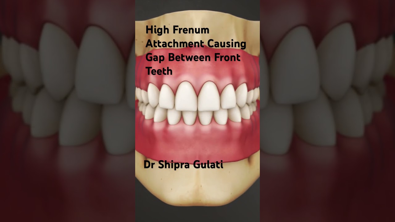 Laser Frenectomy : For High Frenum Attachment