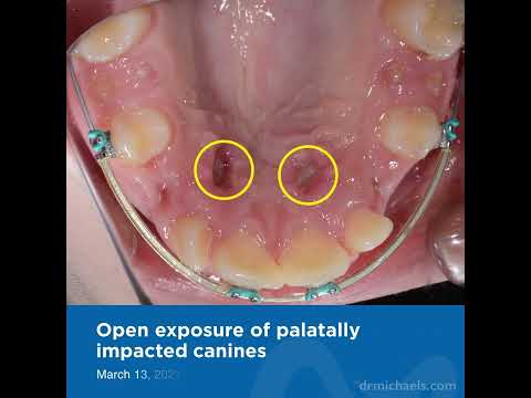 The gradual process of realigning impacted canines through orthodontic treatment by Dr Kasem Atassi