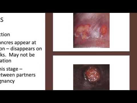 James B. Kaler Lecture Series - Syphilis: The Apple of My STI