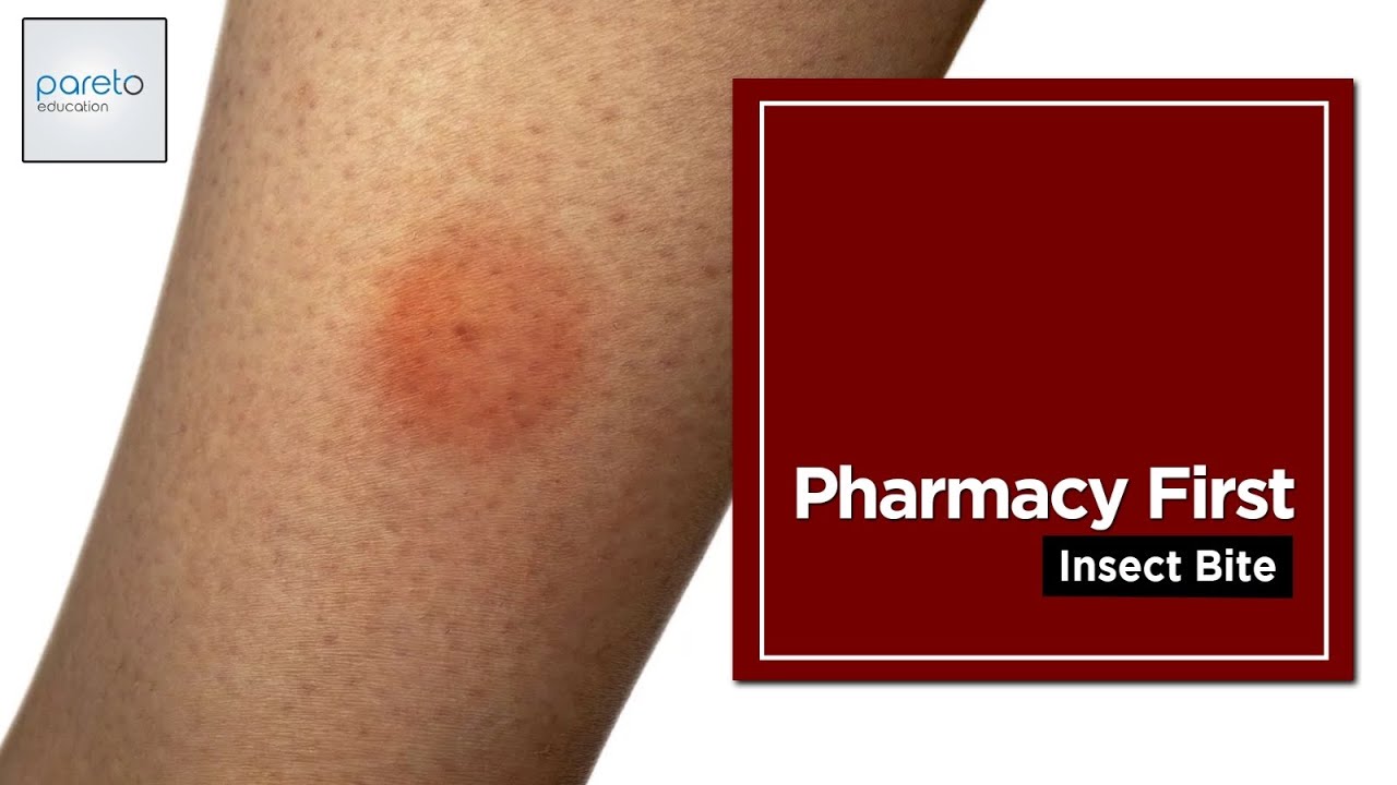 Pharmacy First | Insect Bite | Pareto Education