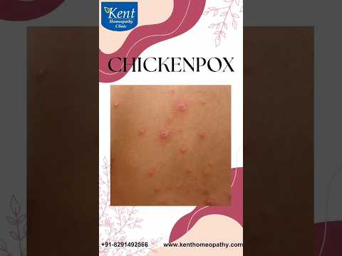Chickenpox - Best homeopathy treatment Drkukreja kalani online consult8291492566