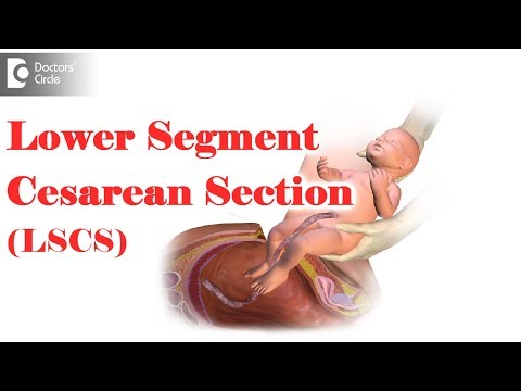 What is LSCS delivery? Are you awake during an emergency C section? - Dr. Mini Salunkhe of C9